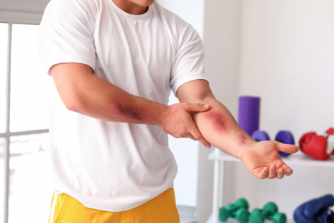 Wylewy podskórne – przyczyny powstawania siniaków i krwiaków | HomeDoctor